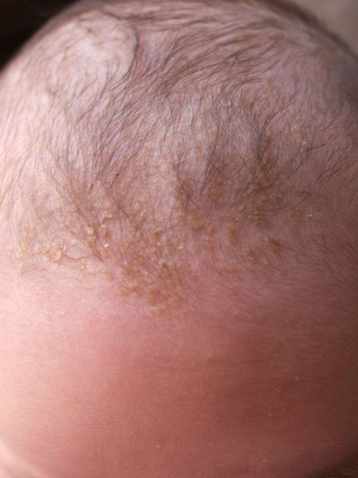 Coconut Oil Home Treatment for Cradle Cap | Organic fiji